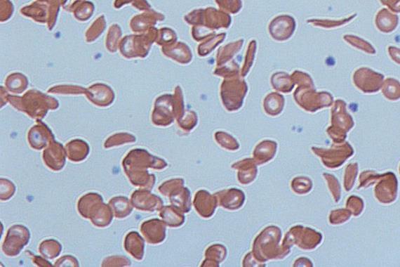 Designing better acute painful sickle cell care | HSJ Partners | Health ...